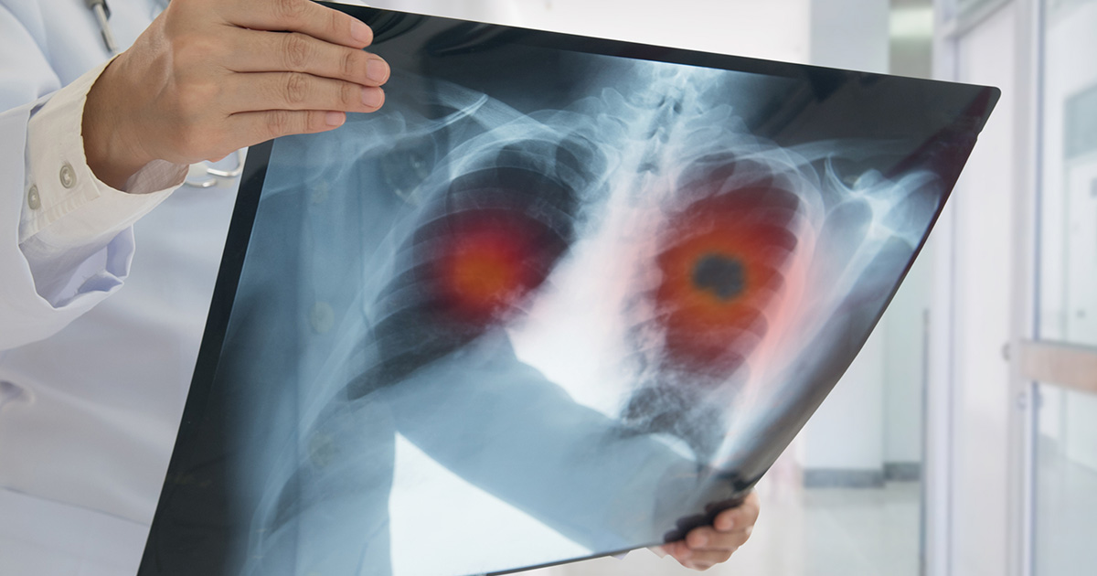 Artificial Intelligence in Medicine: AI Improves Accuracy of Lung ...