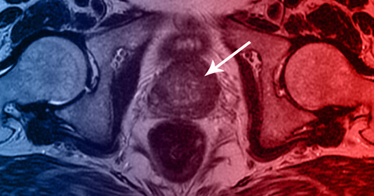 Finally, an Image-Based Way to Predict Prostate Cancer Outcomes ...